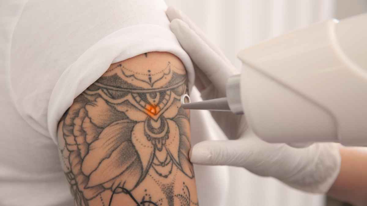 Tattoo Removal - Coconut Botox Tulum